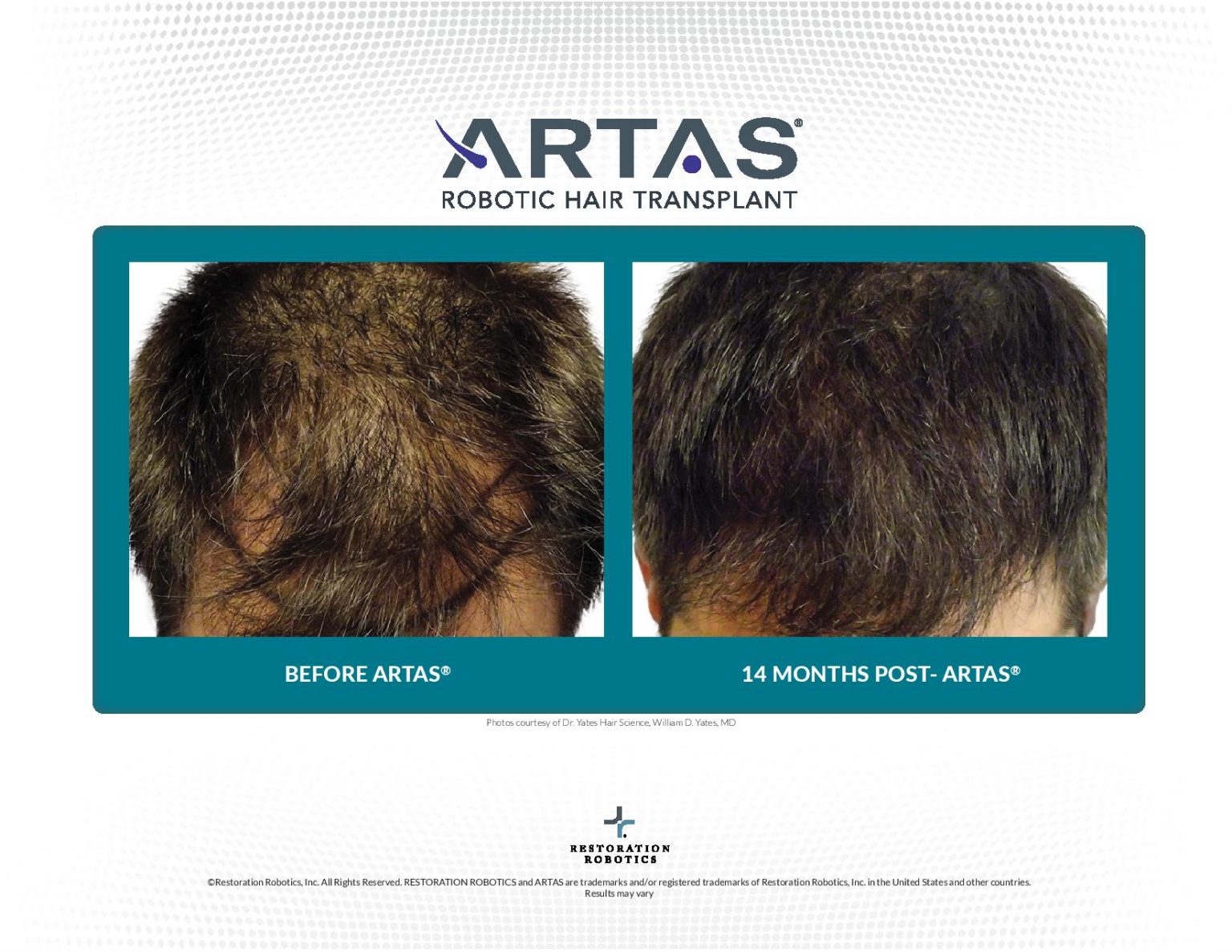 The Ultimate Guide to ARTAS™ Robotic Hair Restoration - Premier Plastic ...