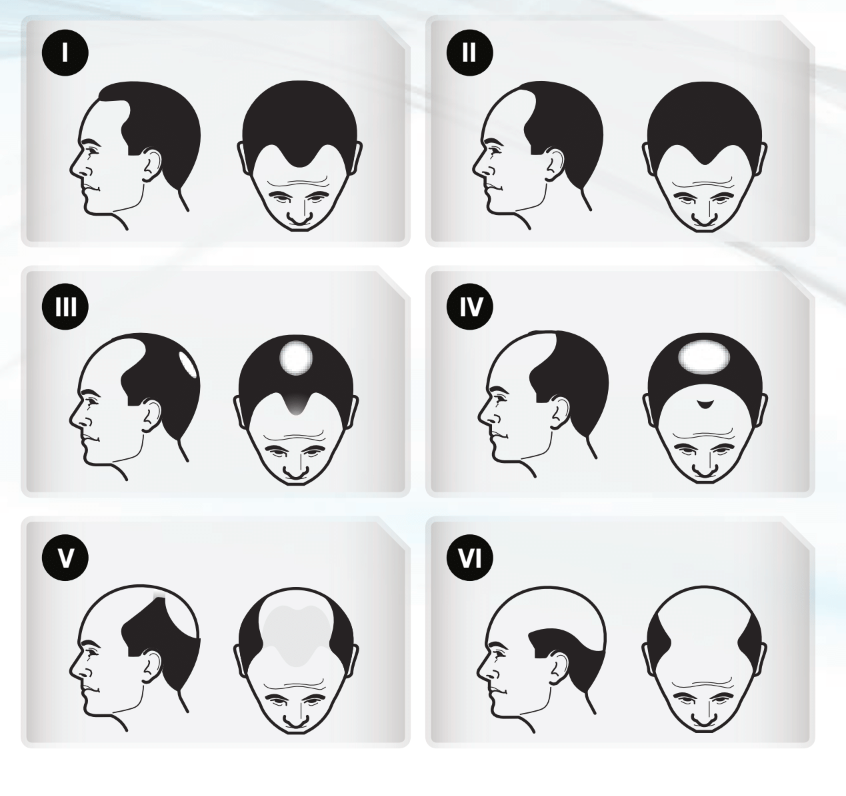 The Ultimate Guide to ARTAS™ Robotic Hair Restoration - Premier Plastic ...